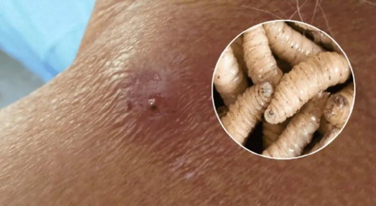 Detectan en México el primer caso humano de miasis - Noticias de Querétaro